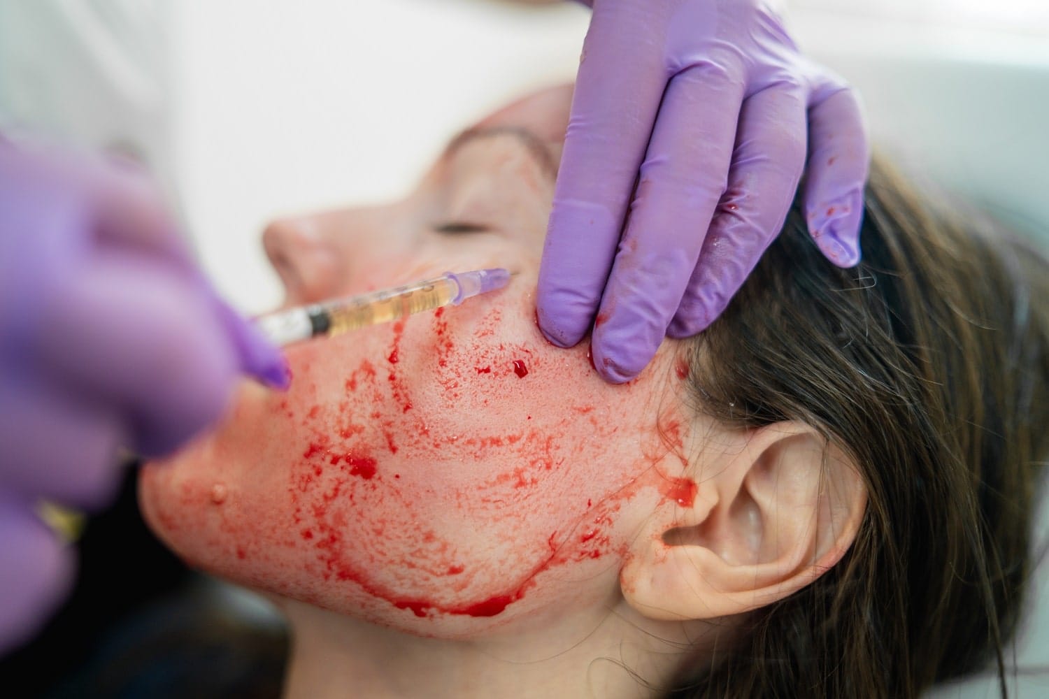 PRP Bali | PRP Vampire Facial Treatments in Ubud