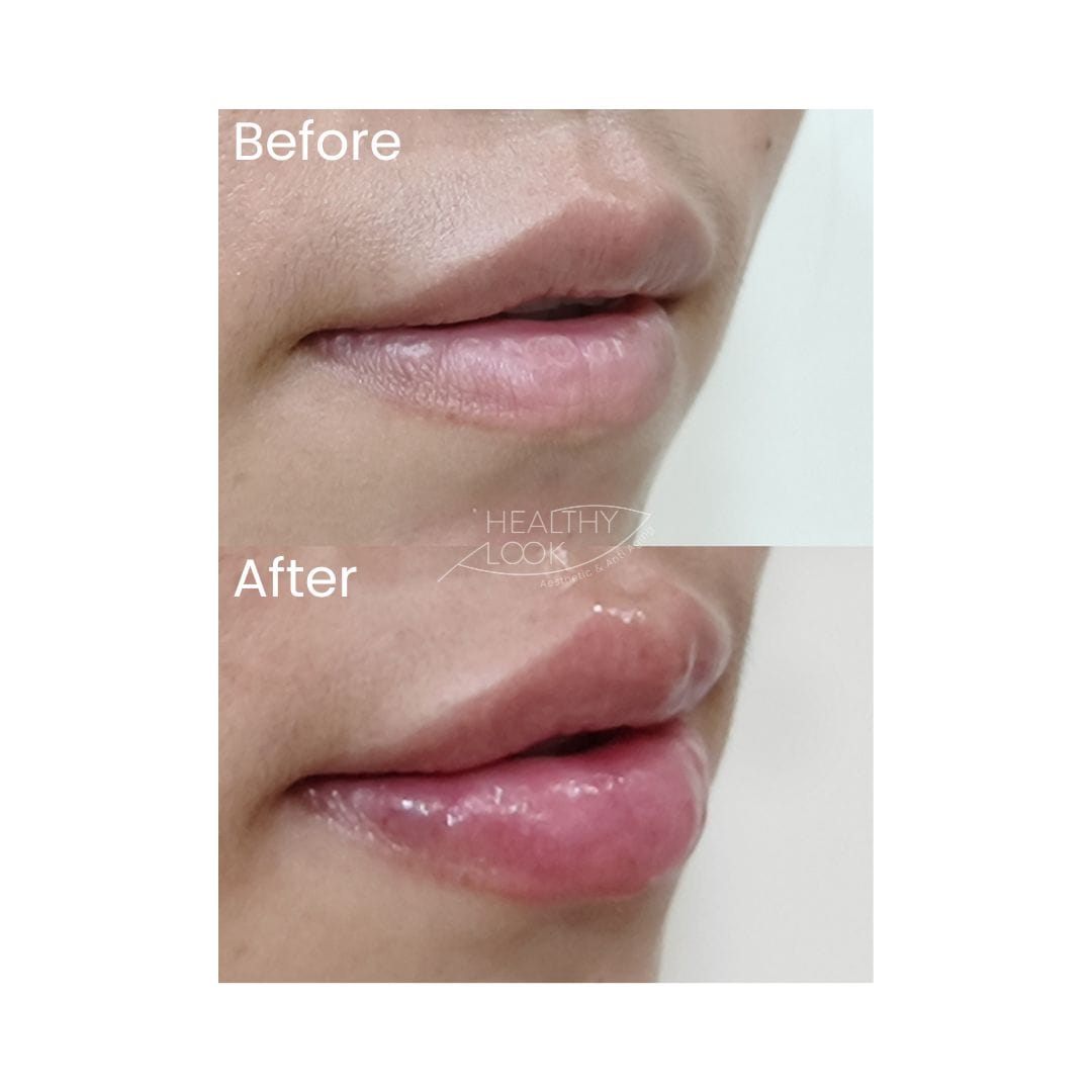 Lip Filler Bali | Premium Lip Filler Treatments in Ubud